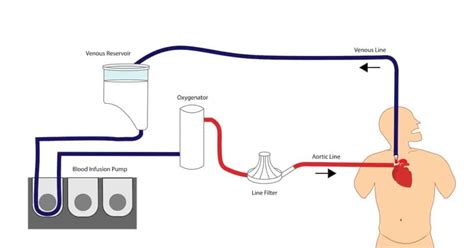 Is Ecmo A Ventilator 2025