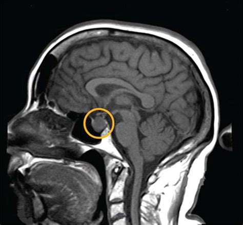 Pituitary Tumor Mri