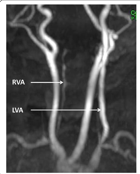 Mr Angiography Showing Hypoplasia And Parietal Irregularities Of The V1
