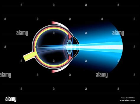 Illustration Of The Astigmatism Eye Condition Astigmatism Is An