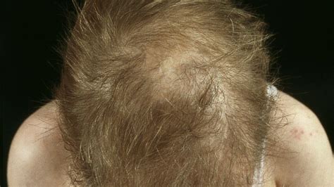 Congenital Ectodermal Dysplasia