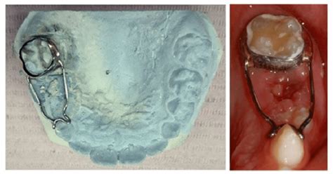 Band And Loop Space Maintainer Working Cast And Clinical Appearance