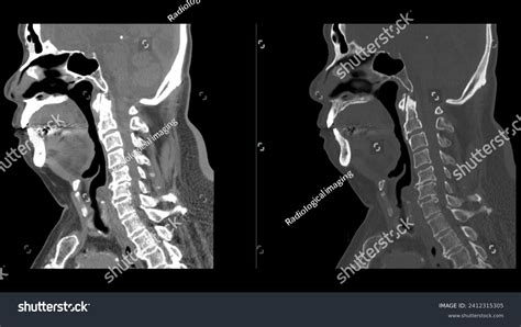 21 Cervical Fracture Detection Royalty Free Photos And Stock Images Shutterstock