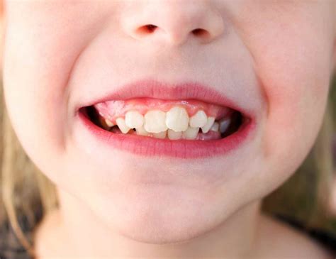 Buck Teeth Braces Solution Causes And Treatments