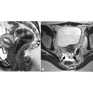 Lymph Node Dissection Download Scientific Diagram