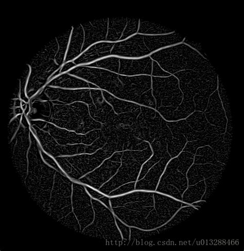 眼底视网膜血管增强方法（五）hessian矩阵最大特征值最大hessian标准 Csdn博客
