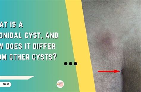 Difference Between A Pilonidal Sinus And A Pilonidal Cyst