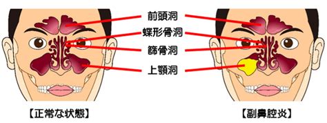 副鼻腔炎（蓄のう症）｜中野区の新中野耳鼻咽喉科クリニック
