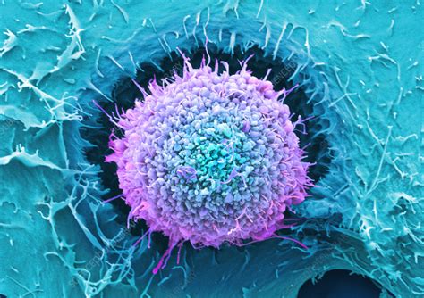 Cervical Cancer Cell Sem Stock Image C0578563 Science Photo Library
