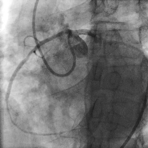 Seperated Lad And Lcx Separate Origins Of Lad And Lcx From The Left Download Scientific Diagram