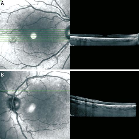 Fundus Fluorescein Angiography Fa In Both Eyes A C Late Phase Fa Download Scientific