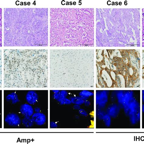 The Design And Performance Of Met Exon 14 Skipping Mutation Qpcr