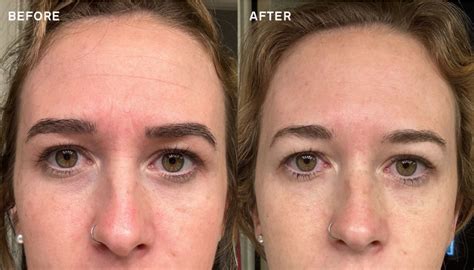 Dermaclara Beautys Occlusion Patches™ Help Scars And Wrinkles