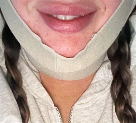 Weird Smile After Chin Lipo Rplasticsurgery