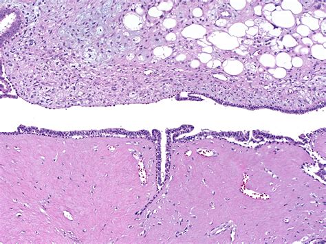 Phyllodes Tumor Mgh Learn Pathology