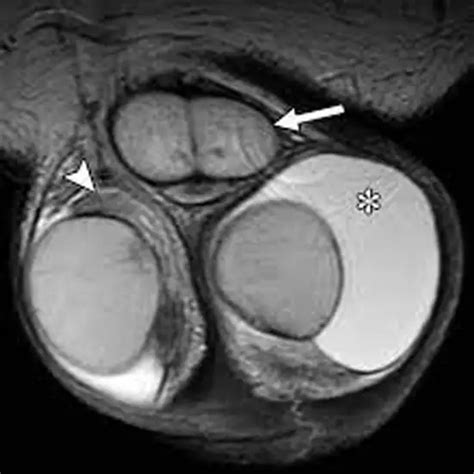 Mri Screening Scrotum Reasonable Rate Medintu