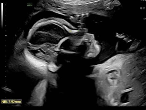 임신일기8 22주 정밀 초음파임당 검사와 입체초음파 예약 네이버 블로그