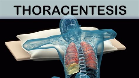 Thoracentesis Medical Animation Youtube
