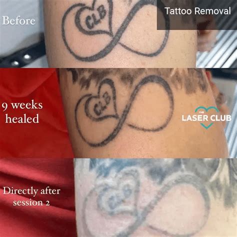 Laser Tattoo Removal Leeds Laser Club