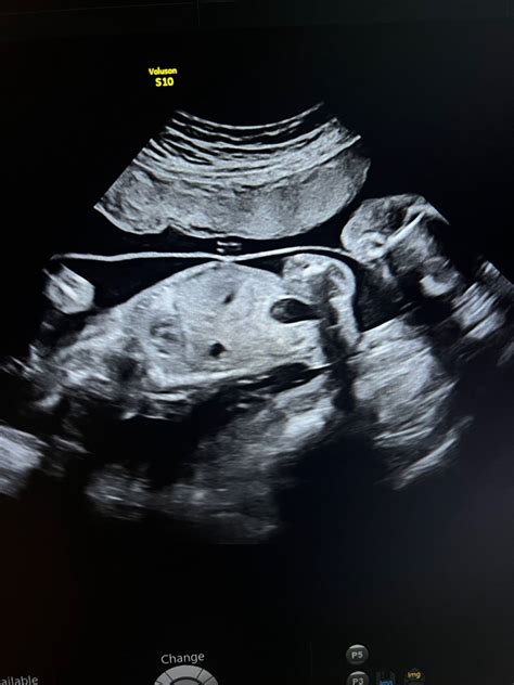 Shorooq Aledreesi On Linkedin Case Of The Day Monochorionic Diamniotic Mcda Twins Mcda Are