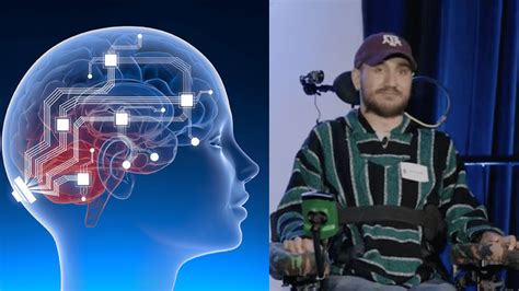 Neuralink S Breakthrough Stumbles First Brain Chip Implant Hits Unexpected Hurdle