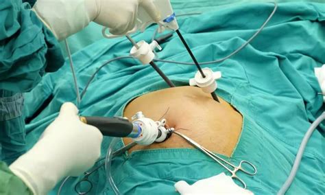 Three Port Laparoscopic Cholecystectomy Safe Option To Standard Four Port Laparoscopic