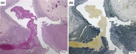 Histological Staining Of A Tissue Specimen From The Site Of The Intimal Download Scientific