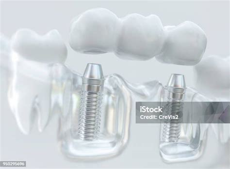 치과 브릿지3d 렌더링 임 플 란 트 치아 임플란트에 대한 스톡 사진 및 기타 이미지 치아 임플란트 가나 강철 Istock