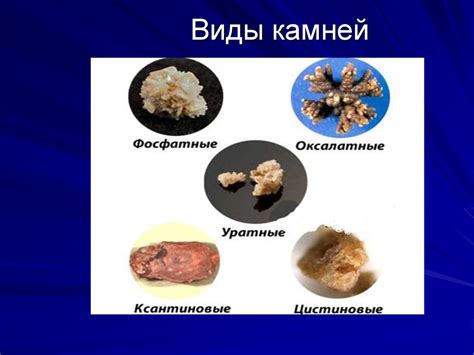Мочекаменная болезнь презентация онлайн