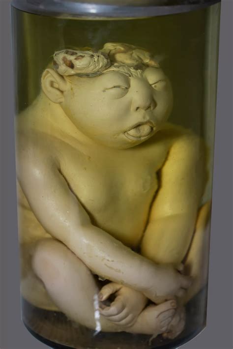 Anencephaly Exploring A Rare Neural Tube Defect