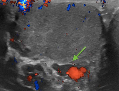 Pampiniform Plexus Ultrasound