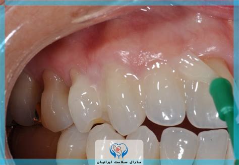 فواید فلورایدتراپی وارنیش فلوراید درمانی در بزرگسالان و کودکان