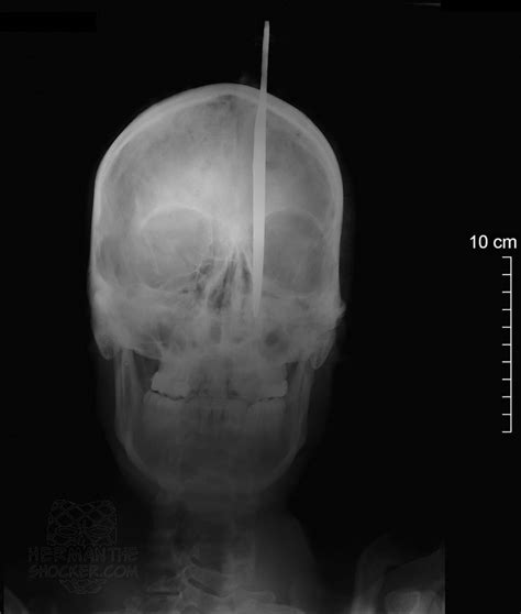 Man Stabbed In The Orbital Bone With A Camo Knife No Known Story R