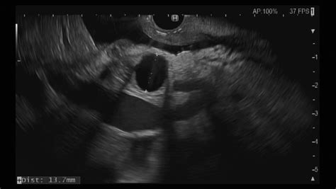 The Common Bile Duct Measured 13 7 Mm Associated With Moderate To Download Scientific Diagram