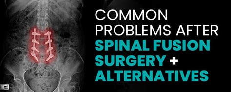 Common Problems After Spinal Fusion Surgery Alternatives