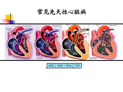 先天性心脏病培训课件11word文档在线阅读与下载无忧文档