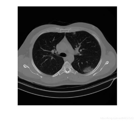 使用pydicom和simpleitk预处理dicom文件dcm改层厚 Csdn博客