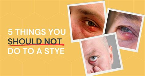 How To Get Rid Of A Stye Fast