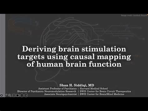 Free Video Deriving Brain Stimulation Targets Using Causal Mapping Of