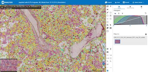 Lung Cancer Diagnostics With Ai Hs Analysis Gmbh