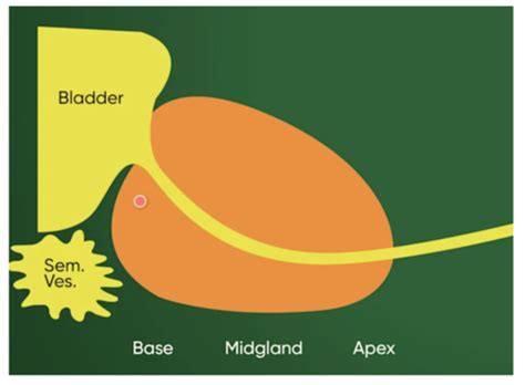 Prostate Seed Implant Brachytherapy Flashcards Quizlet