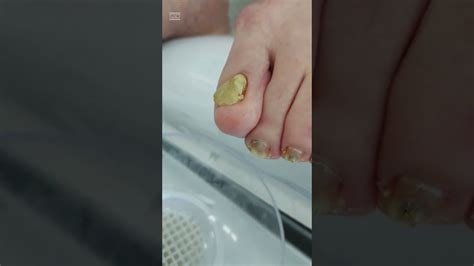 인천에서 제일 실력좋다고 소문난 문제성발 전문샵 케어 발톱무좀 에이풋케어 Youtube