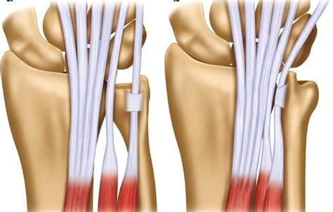The Armdoc Extensor Carpi Ulnaris Subluxation