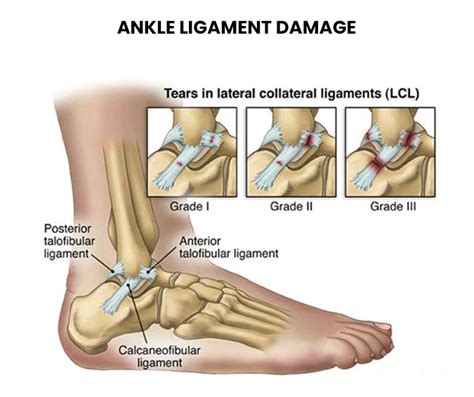 Ligament Sprain