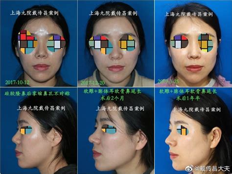 戴传昌做鼻子效果图戴传昌做鼻子风格图片戴传昌大山谷图库