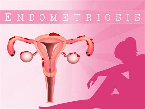 3 Facts About Endometriosis Can I Still Get Pregnant Reunite Rx