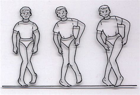 Peds Atypical Postural Control Flashcards Quizlet