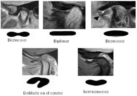Articular Disc Configuration Classification According To Murakami Et Download Scientific