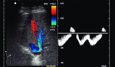 Triphasic Flow In The Hv Type I Download Scientific Diagram