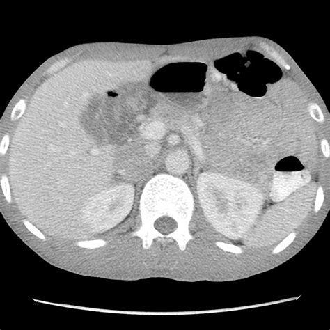 Duodenal Perforation By Alexander Baxter Radnotes
